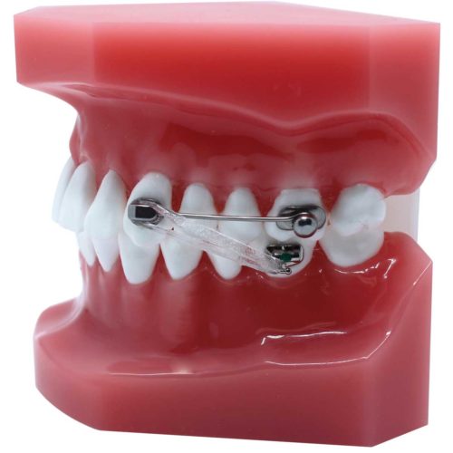 Distalizer - Kit Appareil D2 - Orthoroad